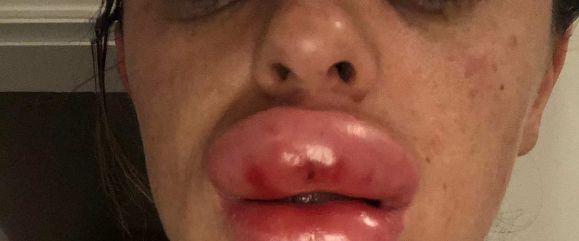 What Are the Risks of Bad Lip Injections?