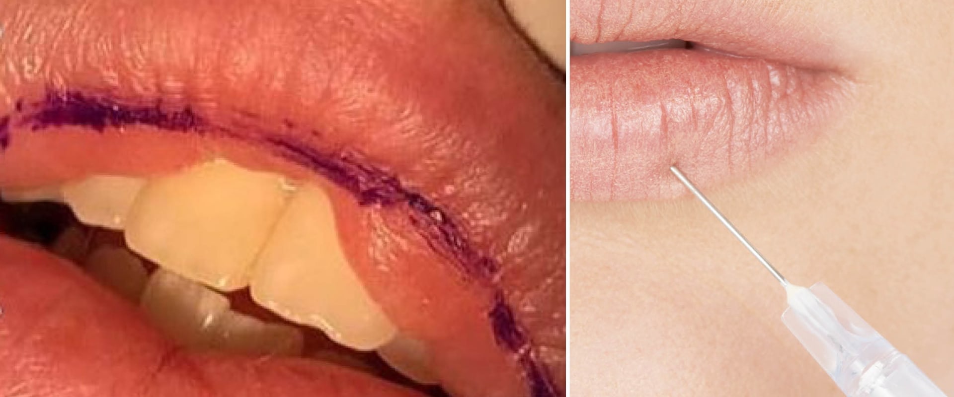 The Dangers of Lip Injections: What You Need to Know